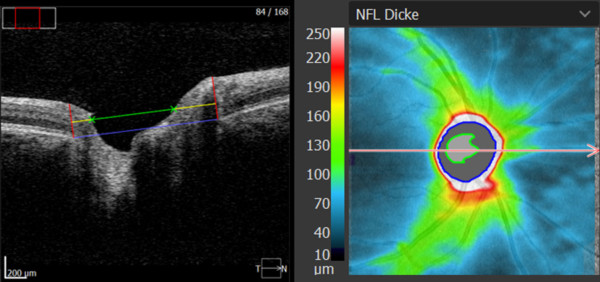 Glaukomdiagnostik – mein OCT