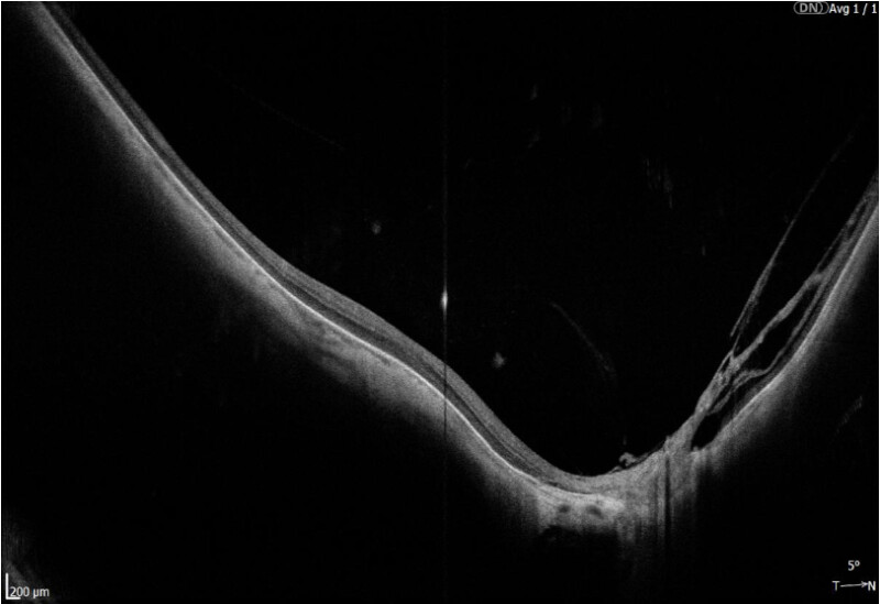 OCT-QUIZ-Frage 6-2 – mein OCT